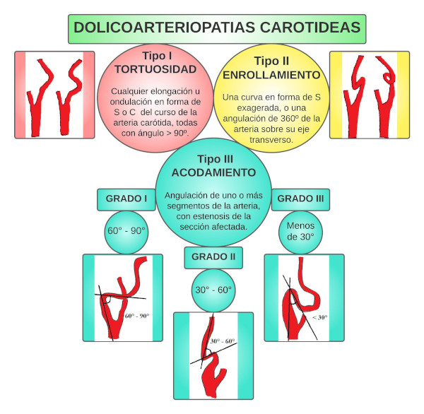 rac - Dolicoarteriopatías carotídeas: un enfoque global