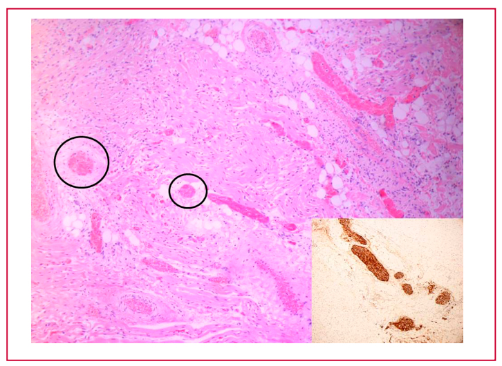El fulcro cardíaco y su relación con el nódulo auriculoventricular