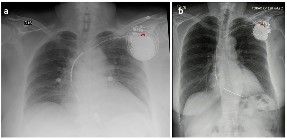 “Flip” Syndrome, a new Mechanism of Lead Macrodislodgement of Cardiac ...