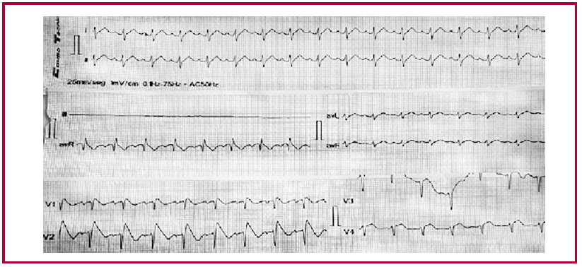 Dengue Fulminant Myocarditis with ECG Brugada Type 1 Pattern